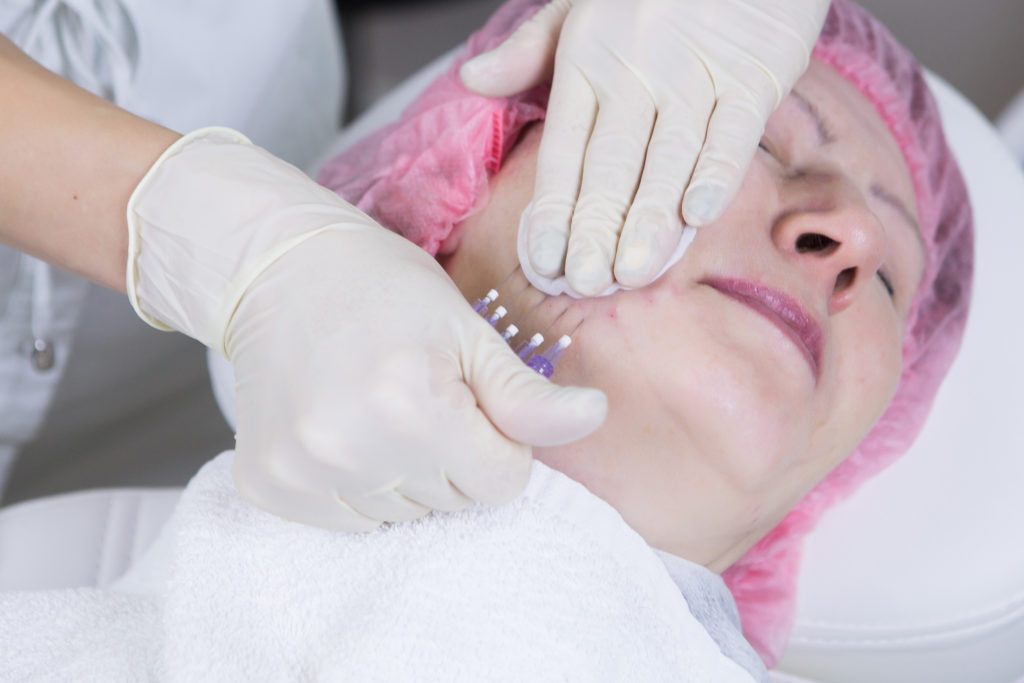 Get Best PDO Thread Lifts in Pittsburgh Aestique Medispa