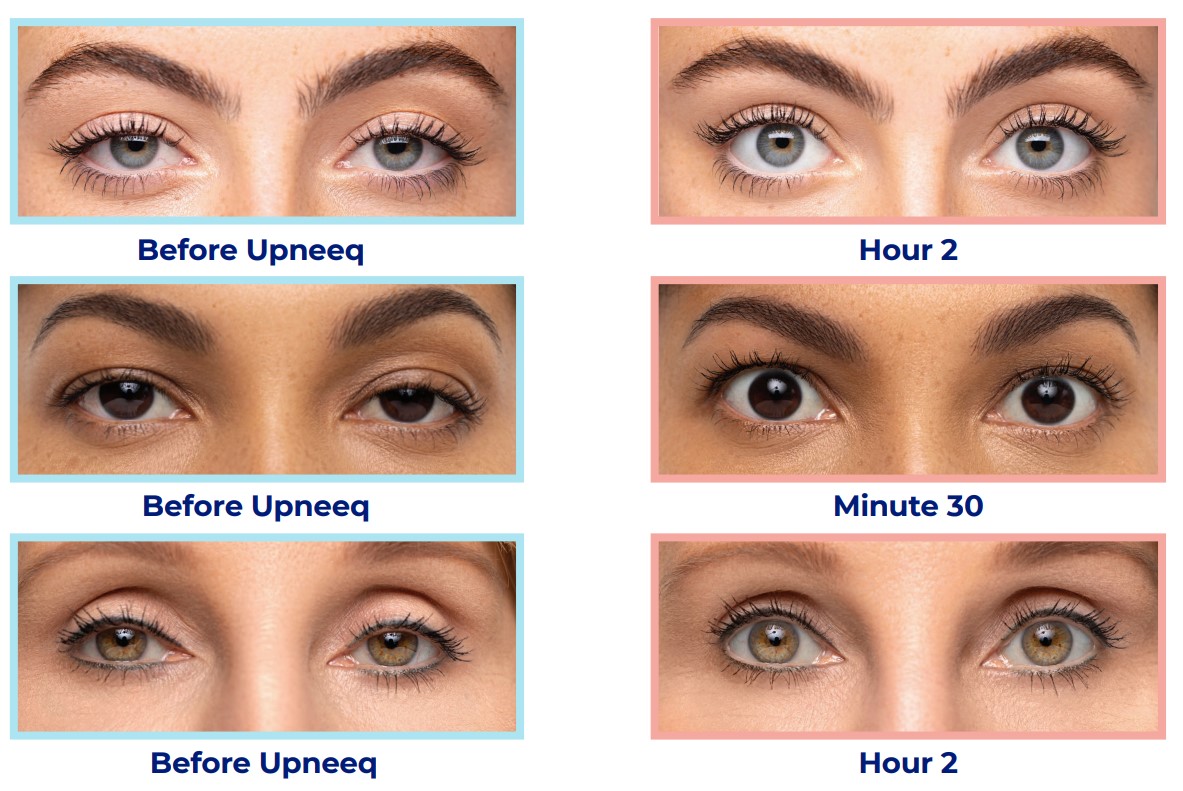 Upneeq low-lying eyelids in Pennsylvania | Aestique MediSpa